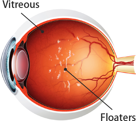 Download What Are The Symptoms Of A Retinal Detachment - Kodak Uv Blue ...