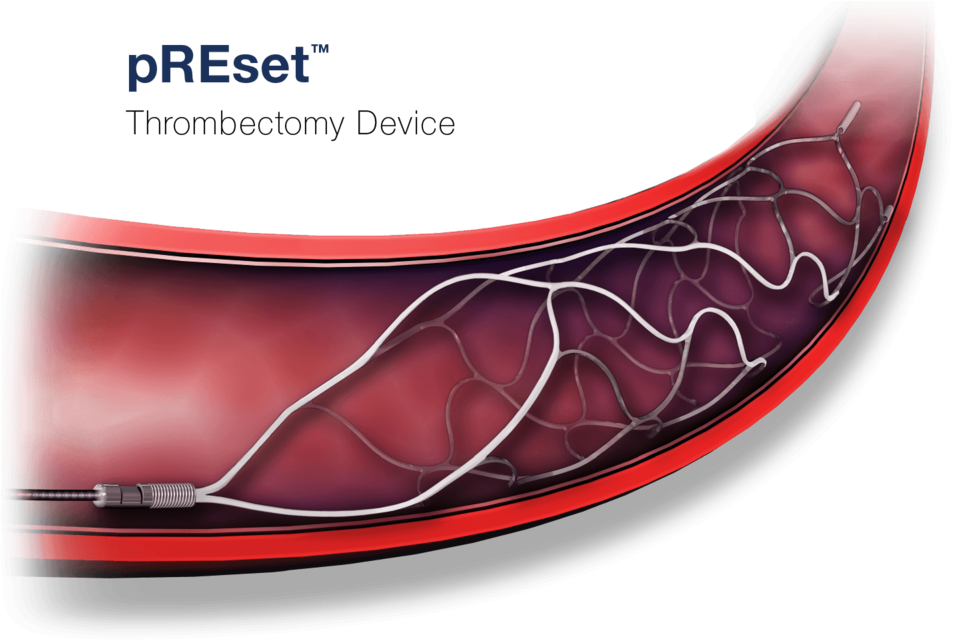 Download Phenox-preset Thrombectomy Device - Diagram - Full Size PNG ...
