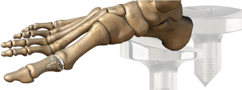 Download Great Toe Implant - Right First Mtpj Semi Metallic Implant ...