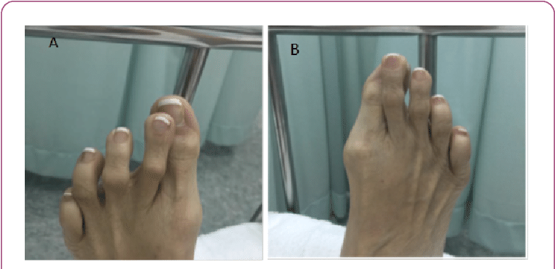 Download The Presence Of Crossover Second Toe Deformity On Both ...