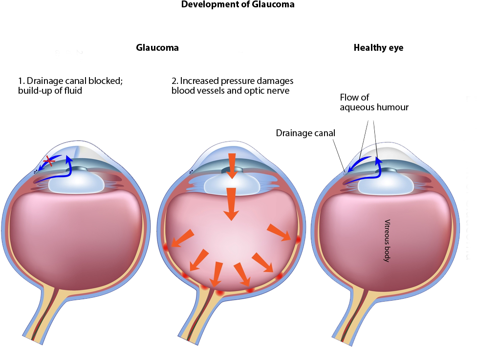 Download Ophthalmic G-probe™ - Laser Cycloablation - Full Size PNG ...
