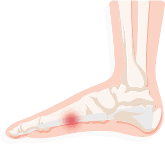 Download Common Treatments Include New Shoes, Arch Supports, - Sock ...
