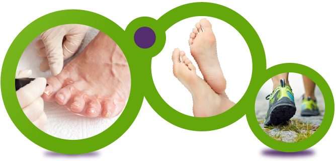 Download Foot Care - Foot Ulcer Causes - Full Size PNG Image - PNGkit