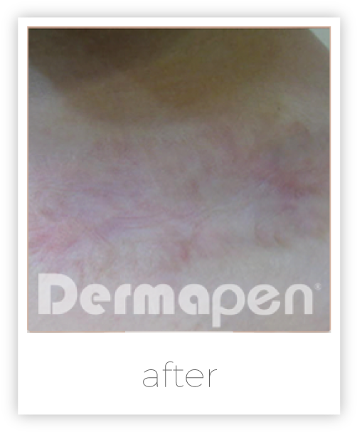 Download Treat Burn Scras - Art - Full Size PNG Image - PNGkit