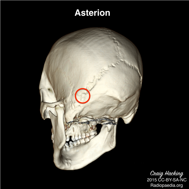 Download Version Of Skull Landmarks Images - Asterion On The Skull ...