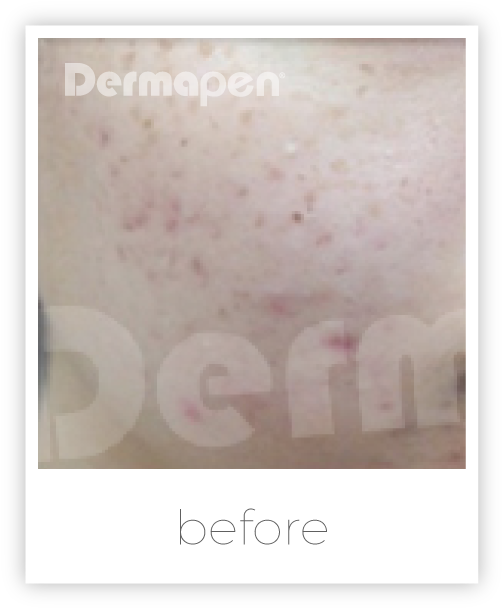 Download Dermapen For Acne Scars - Text - Full Size PNG Image - PNGkit