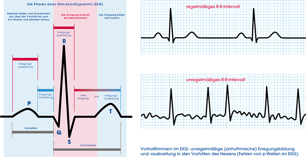 Download Ekg Und Vorhofflimmern - Water Bottle - Full Size PNG Image ...