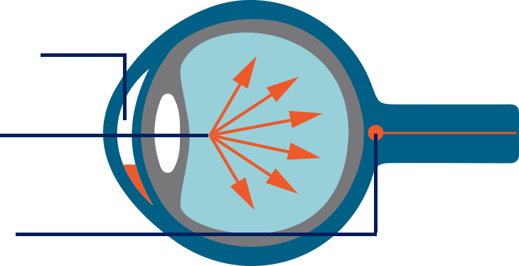 Download Glaucoma - Full Size PNG Image - PNGkit