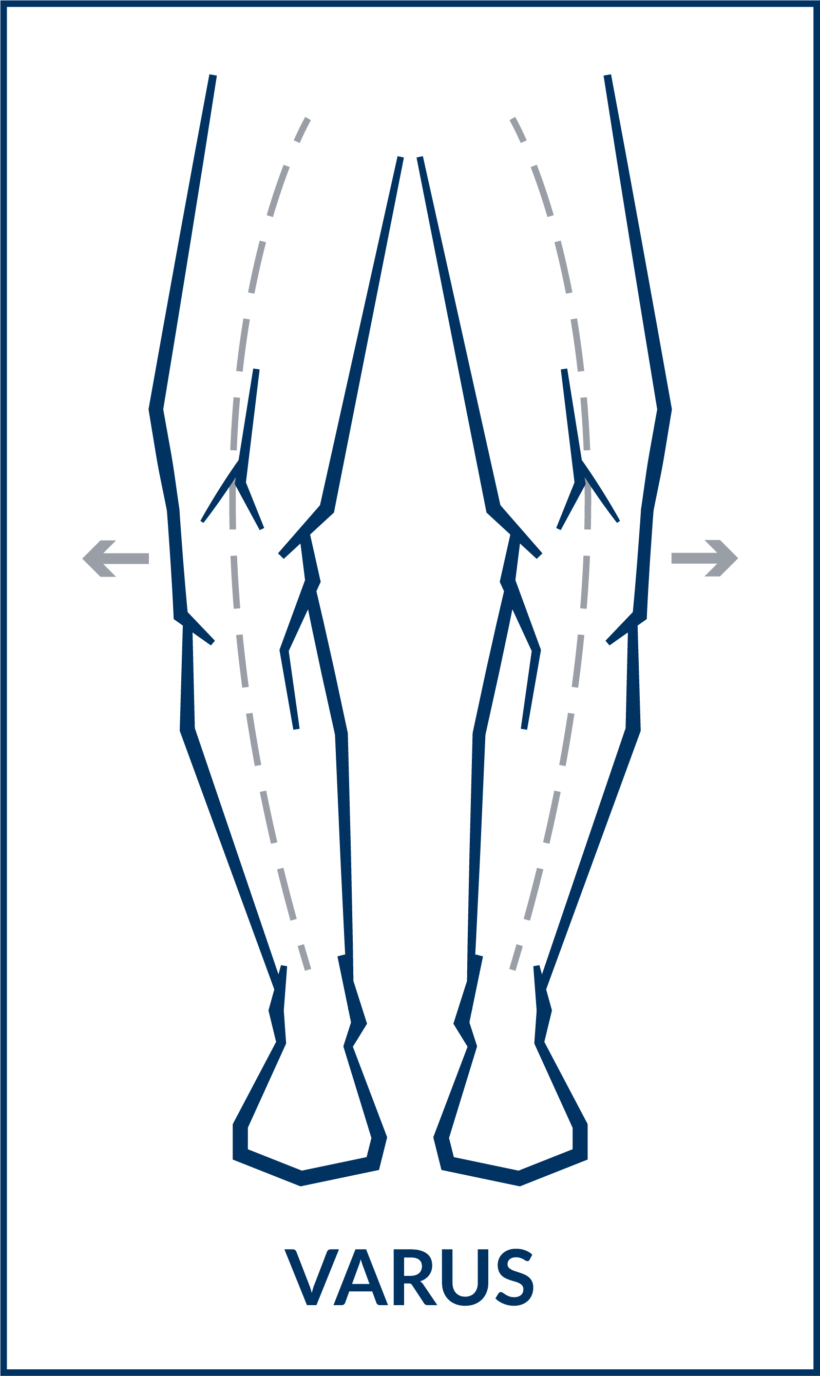 Download Aryse Varus Oa Knee Brace - Varus Deformity - Full Size PNG ...