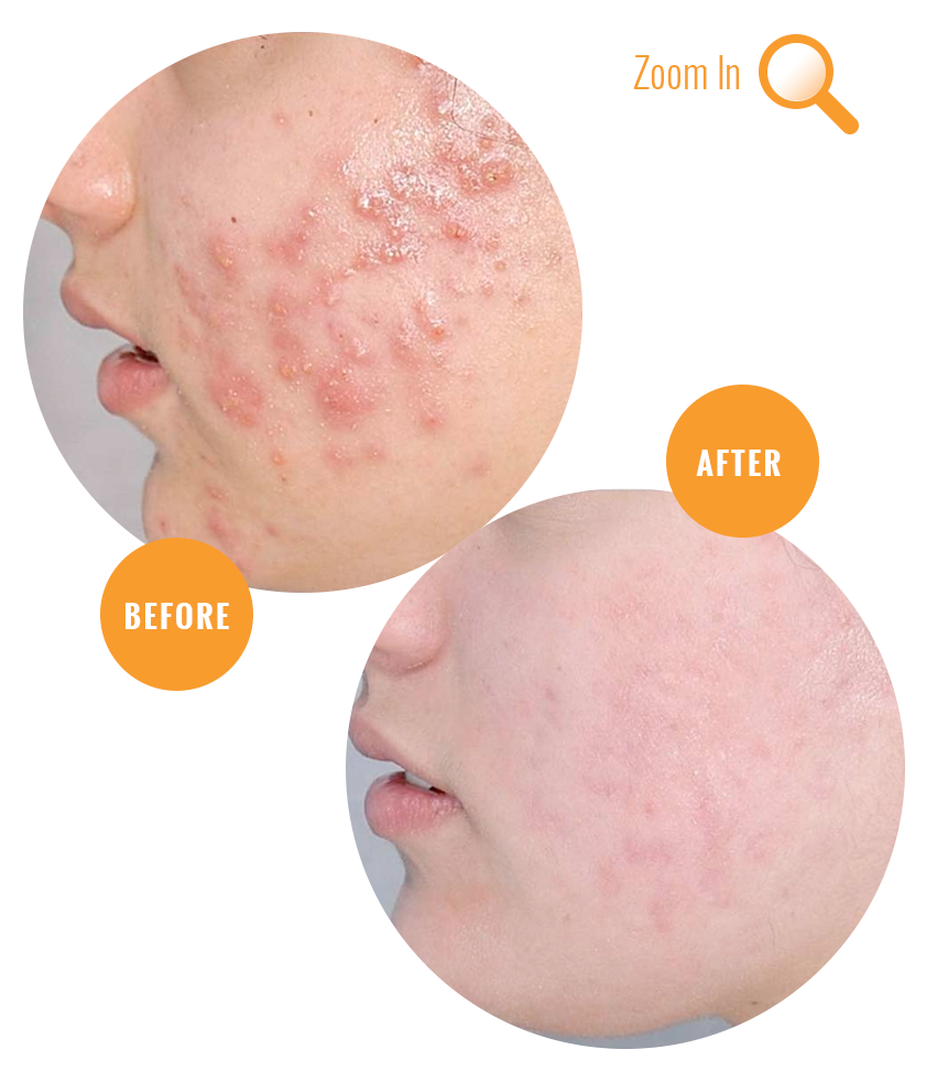 Download Acne Before And After Treatment - Acne Transparent - Full Size ...