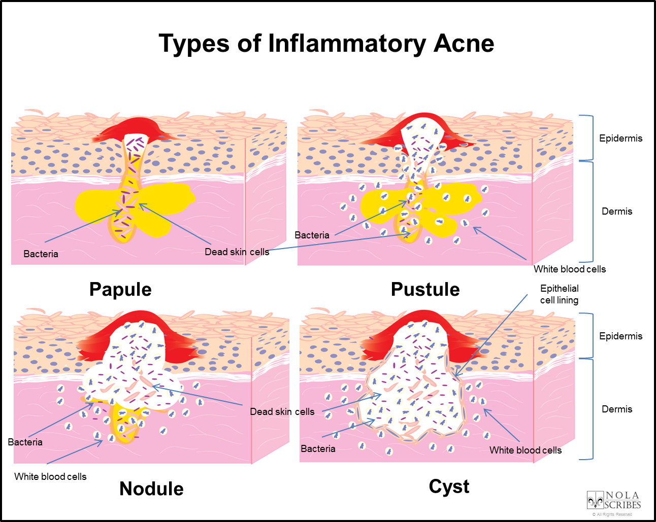 Download Cystic Acne Diagram Health Medicine And Anatomy Reference ...