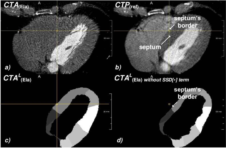 Download A) Registered Image Ct A (ela) Obtained With The Ssd ...