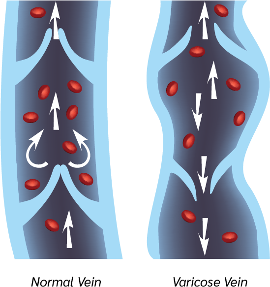 Download Varicose Veins - Vericose Veins Testical - Full Size PNG Image ...