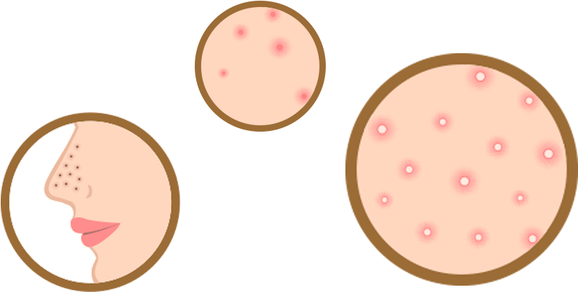 Download Acne - Full Size PNG Image - PNGkit