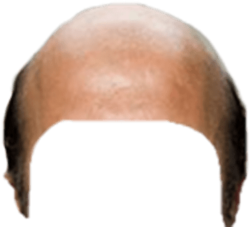 Download Bald Head Snapchat Filter - Bald Png - Full Size PNG Image ...